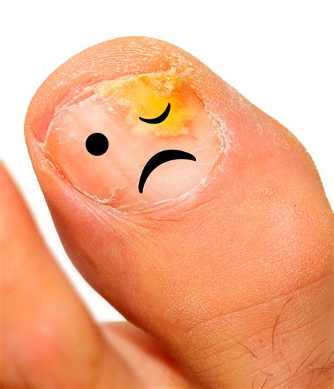 Мази кремы и гели от грибка какое средство выбрать