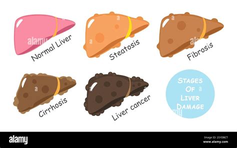 Stages Of Liver Damage Include Steatosis Or Fatty Liver Fibrosis