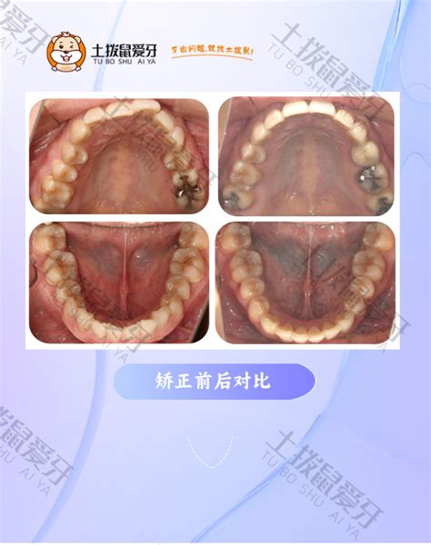 下颌后缩掩饰性治疗 土拨鼠爱牙