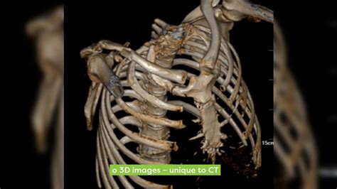 Advantages Of Post Mortem Ct Pmct Advanced Detection Solutions