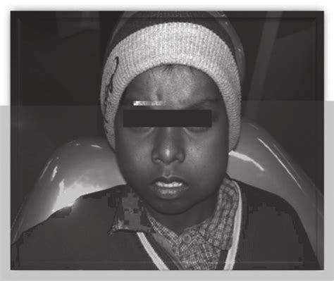 Picture Showing Extraoral Swelling On Left Side Of The Face Source Download Scientific