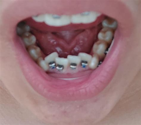 Would Class 3 Elastics Recess The Jaw Rorthotropics