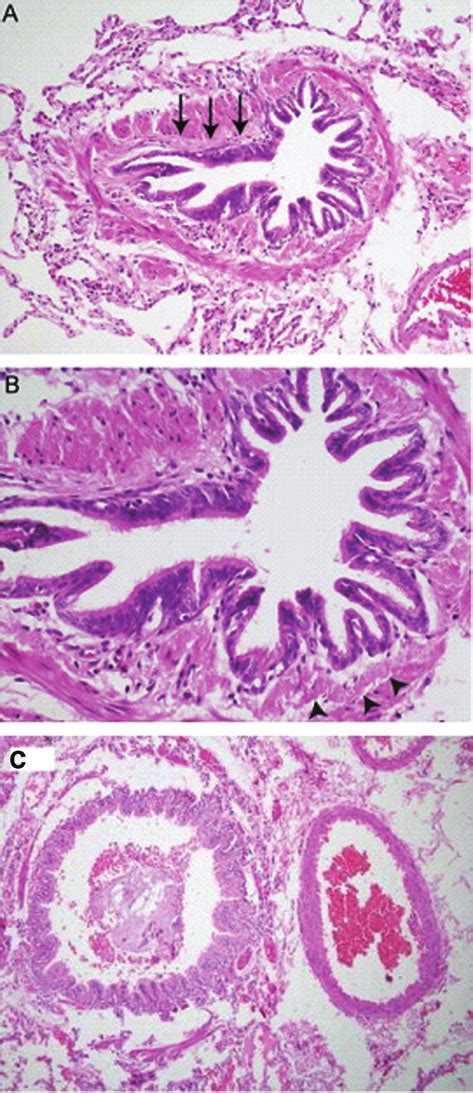 Bronchiolitis Obliterans In Patients With Mild A And B And Severe C