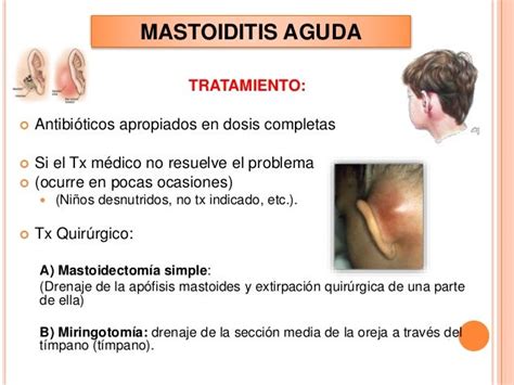 Mastoiditis Aguda