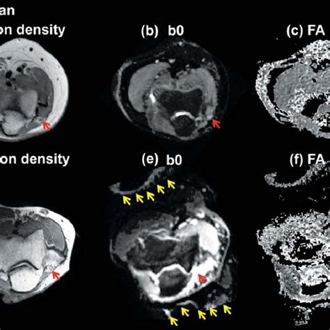 Shading Artifact In The Brachial Plexus A Shading Artifact In The Neck