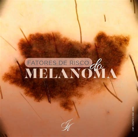 Fatores De Risco Do Melanoma Dra Joyce Arnaut