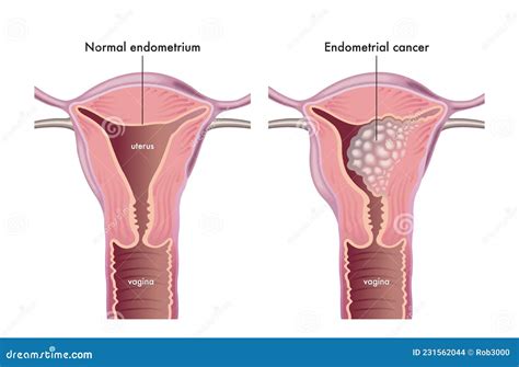 Endometrial Cancer Medical Illustration 231562044