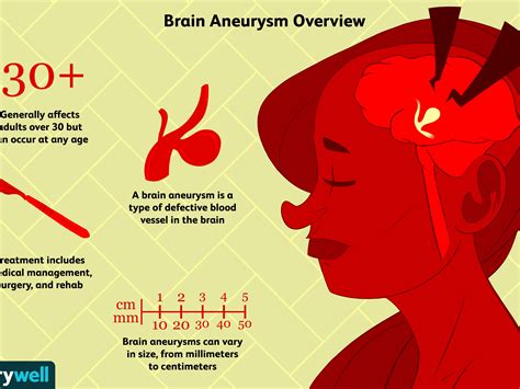 How To Detect An Aneurysm Intelligencesupply16