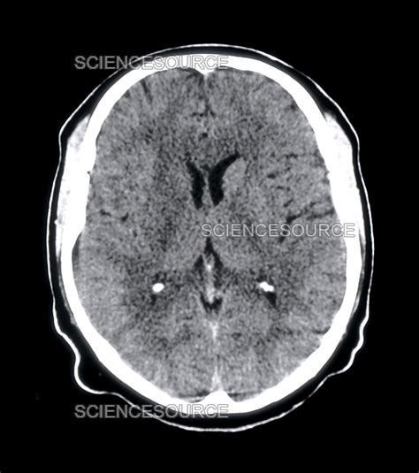 Basal Ganglia Infarct Symptoms Ultrasound Images High