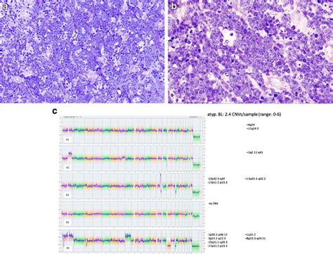 Histomorphology And Copy Number Variations Of Burkitt Lymphoma With