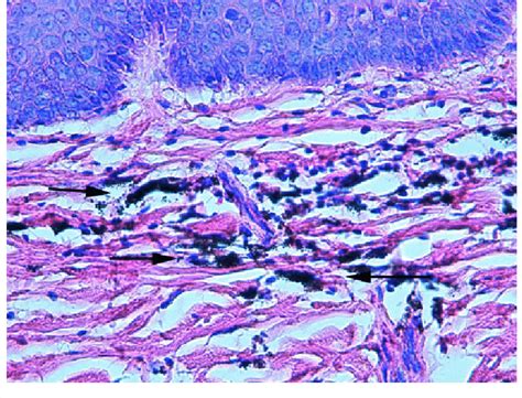The Basophilic Granules Are Chloroquine Metabolites Deposited In The