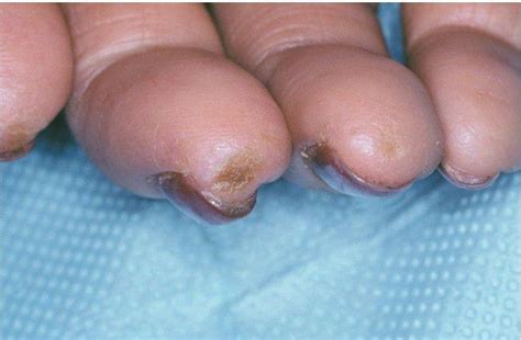 Systemic Sclerosis Medizzy