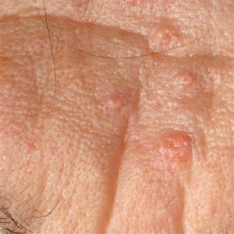 New Skinsations Skin Irregularities