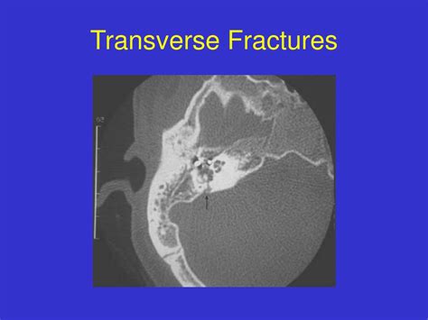 Ppt Temporal Bone Fractures And Surgical Approaches For Csf Leaks