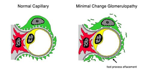 MINIMAL CHANGE DISEASE Histopathology Guru