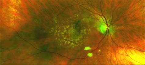 Amd Drusen Colour Retina Doctor