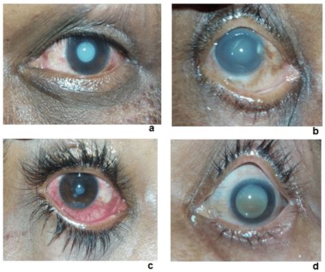 A Left Eye Phacolytic Glaucoma With Mild Grade Corneal Oedma B Right