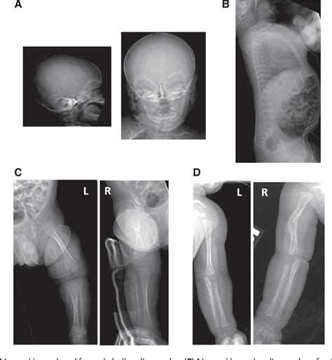 Figure 1 From Milder Presentation Of Osteogenesis Imperfecta Type Viii