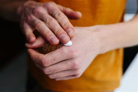 Eczema En Las Manos Manos Femeninas Afectadas Por La Dermatitis Cierre