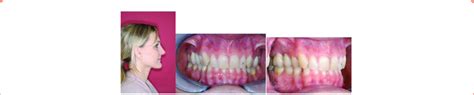 Profile View And Intraoral Photographs Showing The Class Ii 2
