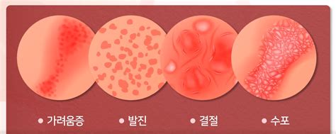 옴증상 원인 검사 치료 경과 합병증 예방방법