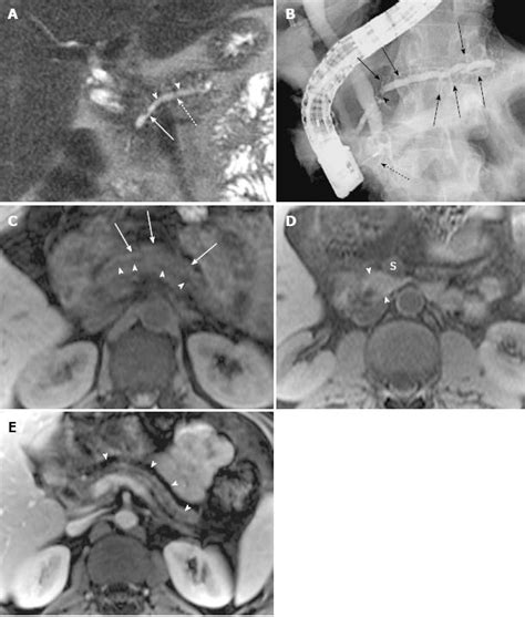Pancreatic Divisum Mrcp