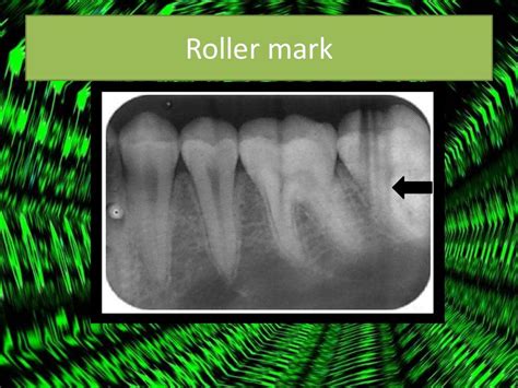 Artifact And Errors In Intraoral Periapical Radiographppt