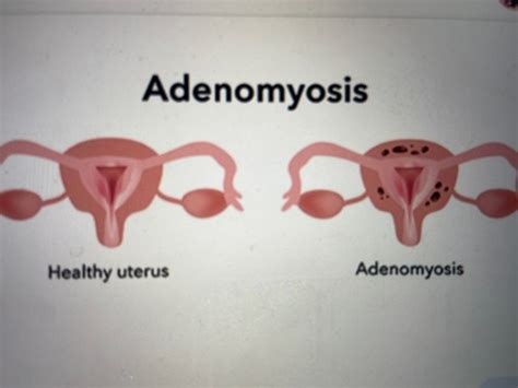 Reproductive Diff Dx Test 3 UC Flashcards Quizlet