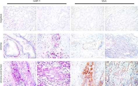 Patterns Of Gbp 1 Expression In Human Prostatic Cancer Representative