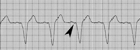Pacemaker Rhythm Equimedcorp
