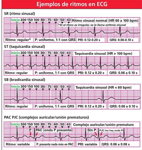 Dr L Some Ekg Patterns