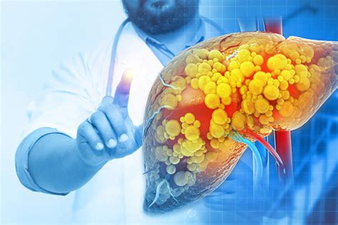 Stłuszczeniowa choroba wątroby wczesna diagnoza jest kluczowa e Akademia MAFLD Termedia