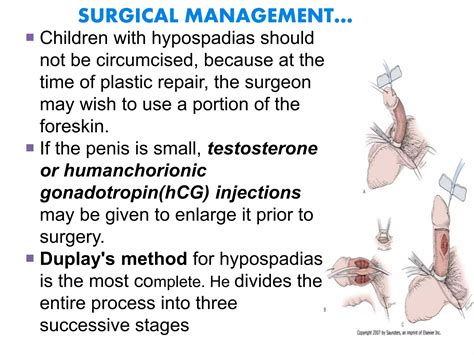 Nursing Management Of Patient With Hypospadiasis And Epispadias Ppt
