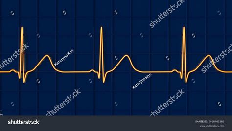 3d Illustration Electrocardiogram Ecg Showing Prolonged Stock Illustration 2466461569 Shutterstock