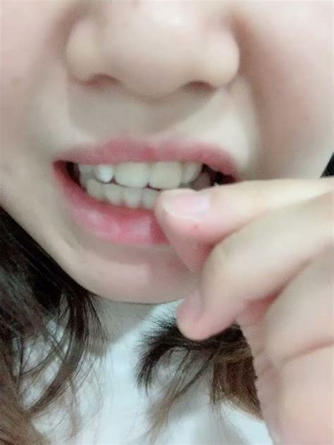 앞니 임플란트 묘기 Youtube