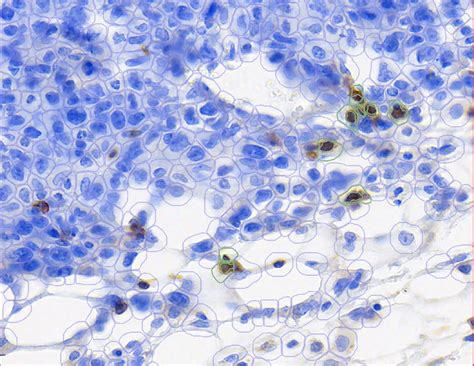 Qupath Isn T Counting All Of My Brown Cells Image Analysis Image Sc
