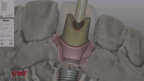 Custom Abutment Digital Dentistry Babeogy