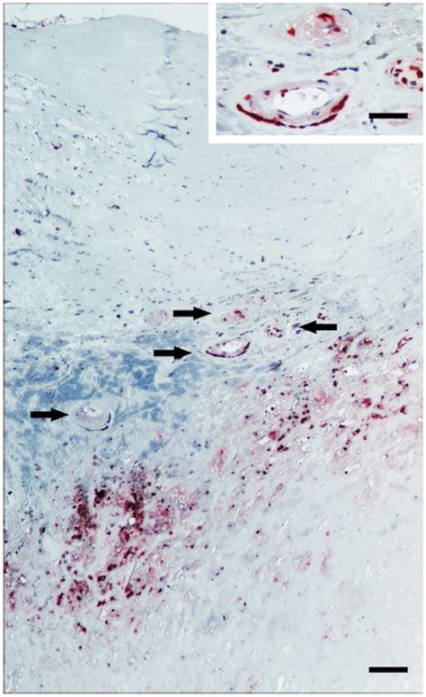 Immunohistochemical Staining Of Cd66b Cells In A Plaque Download