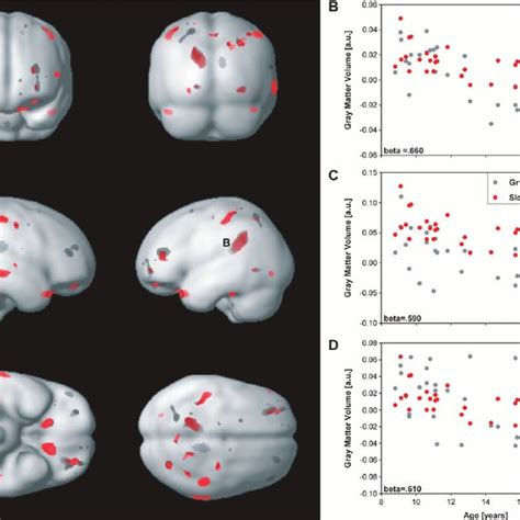 Colocalization Of The Correlation Between Age And Cortical Thickness