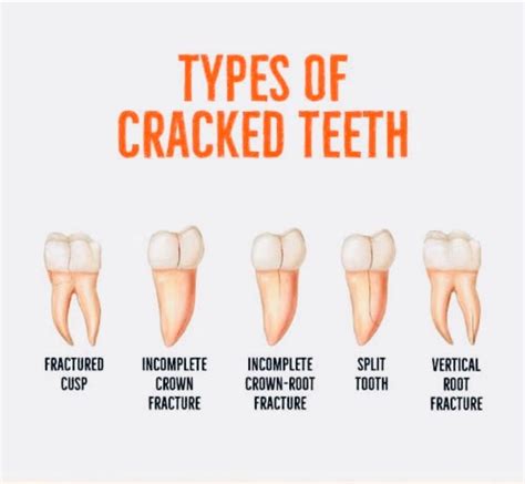 How To Diagnose Cracked Teeth A Comprehensive Guide Dr Sharif Zahin