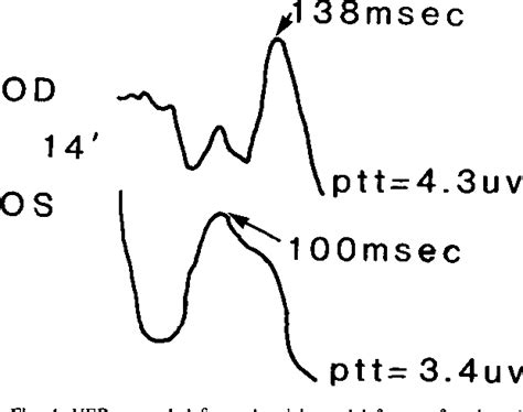 Figure 1 From Visual Evoked Potentials In Macular Disease Semantic Scholar