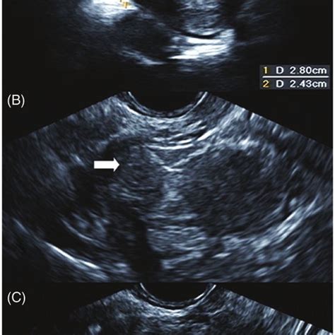 Pdf Accessory And Cavitated Uterine Mass In An Adolescent With Severe