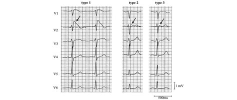 Brugada Syndrome One Heart Cardiology