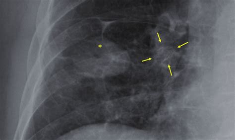 Resolution Of Pneumothorax After Implantation Of An Endobronchial Valve Download Scientific