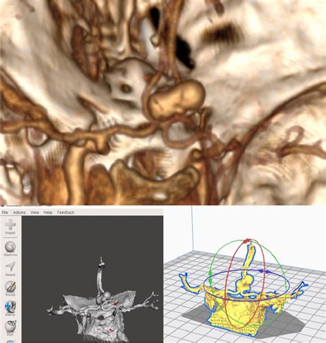 Screen Images From Computer Programs Used For 3d Aneurysm Modeling Of A Download Scientific