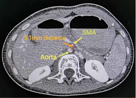 SMAS Superior Mesenteric Artery Syndrome Research Awareness And Support