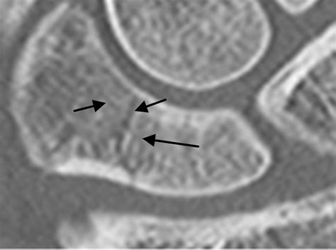 efficacy of high resolution computed tomography for detection of early