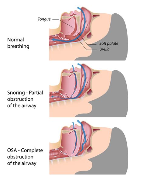 Snoring And Sleep Apnoea Andrew Foreman Ent