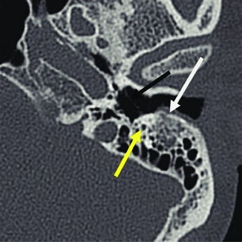 Hrct Temporal Bone Of Left Side Showing Soft Tissue Mass In Left Download Scientific Diagram