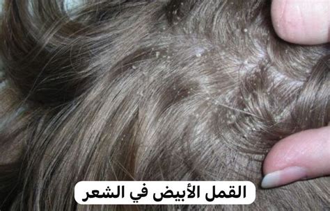 تفسير حلم القمل في الشعر وقتله للمتزوجه العرب اليوم